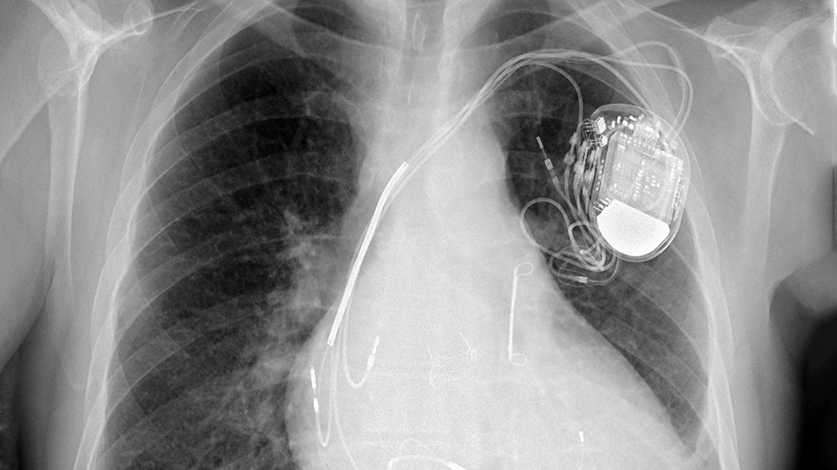 Cardiac Synchronization Therapy: A Closer Look at How CRT Devices ...